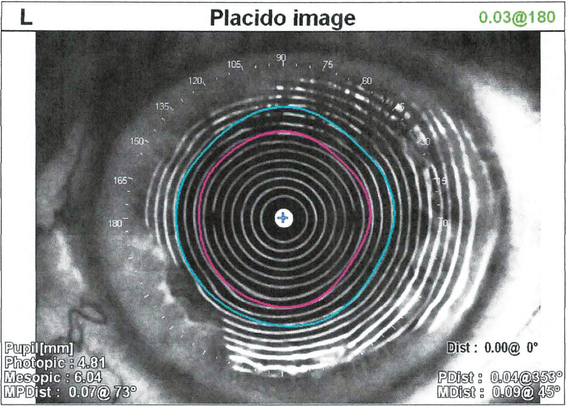 A Quick Way To Diagnose And Treat Dry Eye Disease Patients Prior To ...